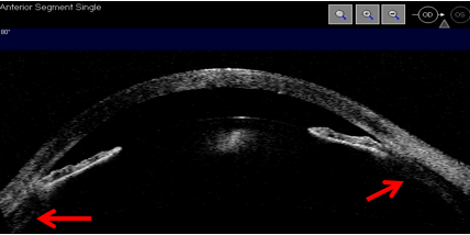Imagiologia do segmento anterior: Qual o seu interesse em Glaucoma ...