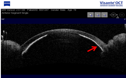 Imagiologia do segmento anterior: Qual o seu interesse em Glaucoma ...